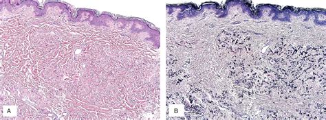 The Utility Of Elastic Verhoeff‐van Gieson Staining In Dermatopathology