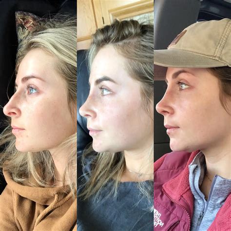 Septorhinoplasty Before Vs 3 Weeks Vs 7 Weeks Post Thin Skin Scrolller