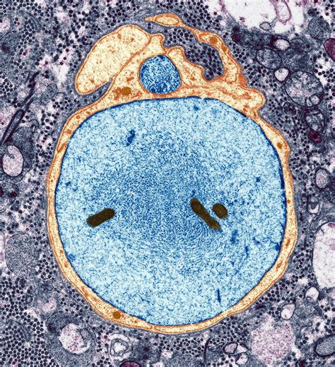 Demyelinated Nerve In Multiple Sclerosis Stock Image M2100305