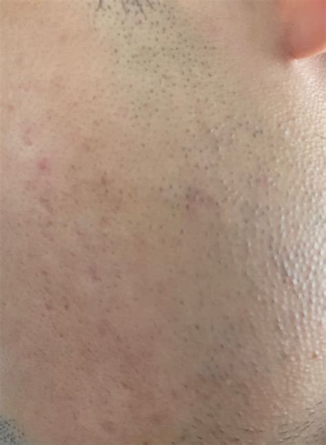 피부에 여드름 같은 지식in