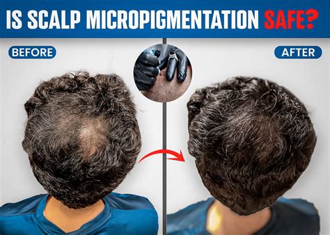 Can Scalp Micropigmentation Be Removed Understanding The Reversal