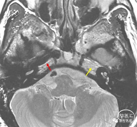 影像读片（47）：颈内动脉未发育（先天缺如）的dsa Ct 管壁mri诊断表现 脑医汇