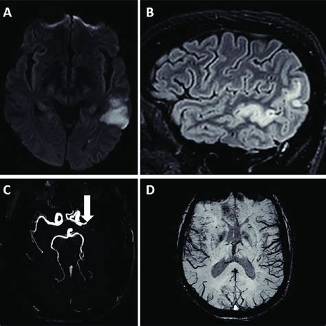 Broca And Left Rolandic Operculum Acute Ischemic Stroke In A
