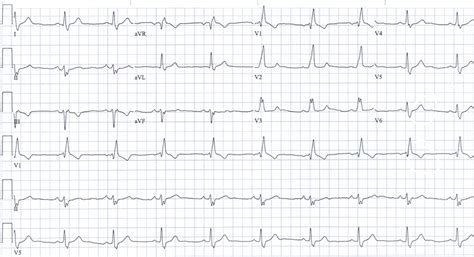 Bifascicular Block Ecg Book