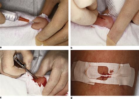 The Procedure Of Muscle Biopsy Musculoskeletal Key