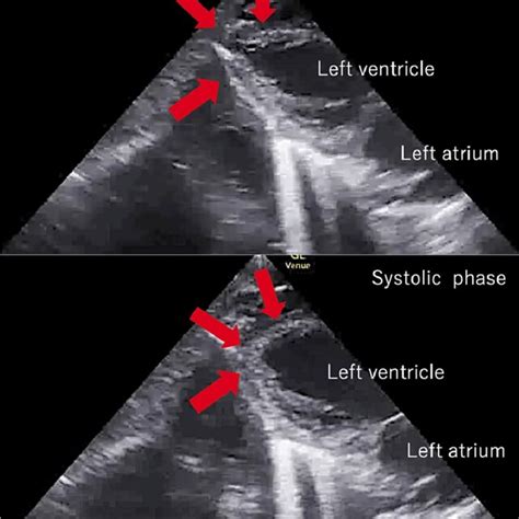 Echocardiogram On Admission Comparison Of Diastolic And Systolic Echocardiogram On Admission Comparison Of Diastolic And Systolic