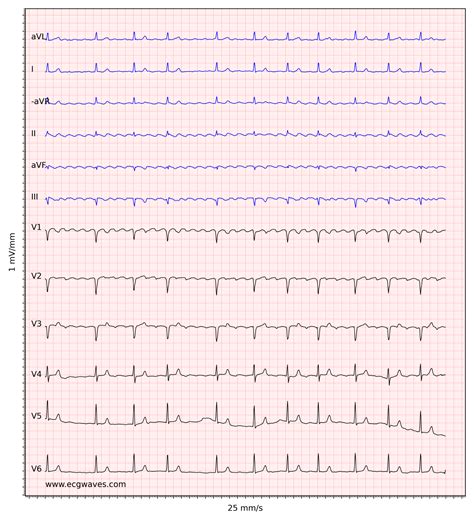 Atrial Flutter Classification Causes Ecg Criteria And Management The Cardiovascular