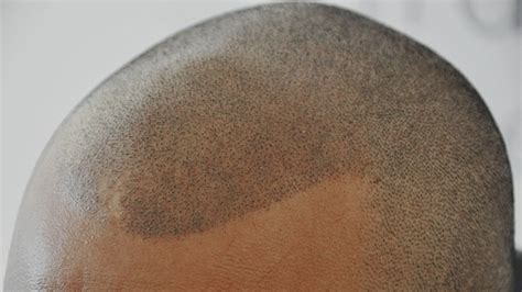 Scalp Microblading Explained The Ultimate Guide Microblading Training