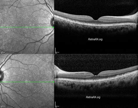 Reticular Drusen Retinara
