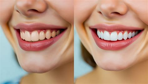 Professional Teeth Whitening Before And After Expectations Fashionabc