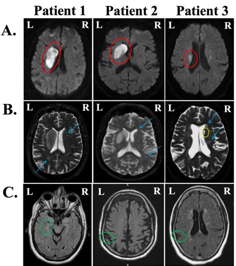 Clinical Images From The Three Patients With Marked Language Deficits