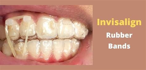 Invisalign Elastics Powering A Straight Healthy Smile