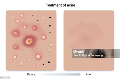 여드름의 치료 치료 전후의 피부 블랙 헤드 화이트 헤드 구진 농포 결절 및 낭종 아름다움과 치료에 대한 광고를위한 벡터 건강