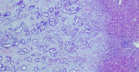 Providing Optimal Clinical Care For Cholangiocarcinoma Subtypes