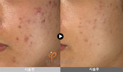 피부치료전후사진 여드름 여드름흉터 기미잡티 모공등 다양한 전후모습을 직접확인해보세요