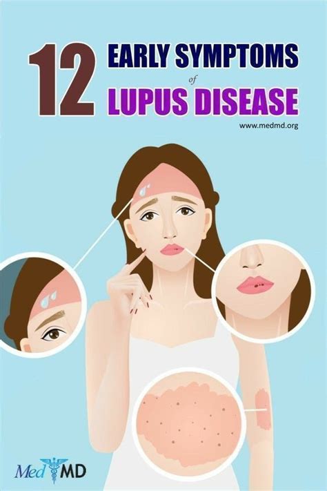 Lupus In Women Lupus Facts Lupus Symptoms Lupus Rash