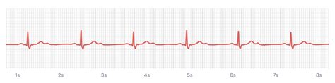 What Second Degree Av Block Type 2 Looks Like On Your Watch Ecg Qaly