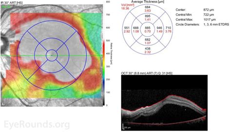 Atlas Entry Bilateral Serous Retinal Detachments From Acute Hypertensive Retinopathy