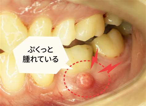 歯茎の白いできものこれって口内炎 野田阪神アルプス歯科公式野田阪神海老江福島区の歯医者さん