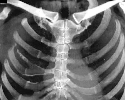 Median Sternotomy