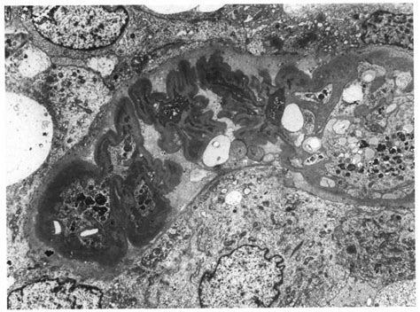 Electron Micrograph Illustrating An Advanced Stage Of Glomerular Download Scientific Diagram