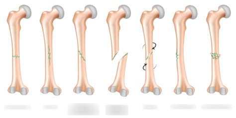 Types Of Bone Fractures Diagram Quizlet