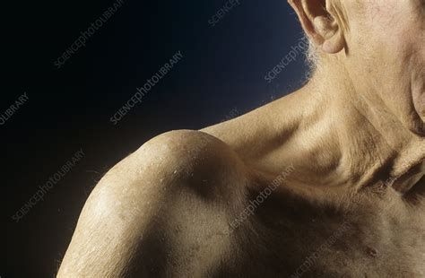 Shoulder Joint Cyst Stock Image M1300890 Science Photo Library