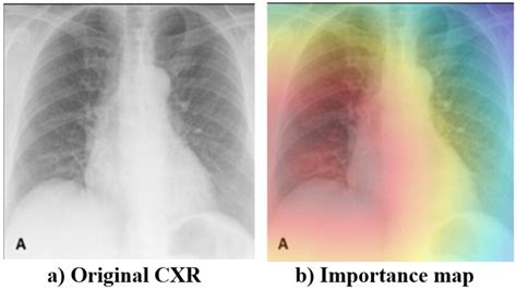 The Cxr Image Indicates The Infected Areas With Pneumonia Download