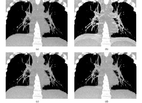 The Mips Of Interpolated Slices Of Real Ct Data Set A Linear B Download Scientific