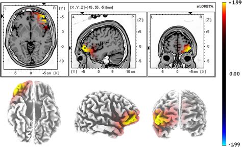 Source Localization Results Eloreta Increased N1 Related Activation