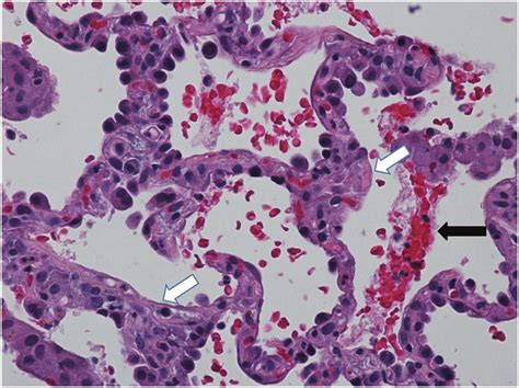 Lung Biopsy Showing Alveolar Hemorrhage Black Arrow And Hyperplasia