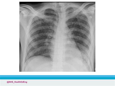 Abcde Cxr Final Version Pptx Lung And Respiratory Health Diseases And Conditions