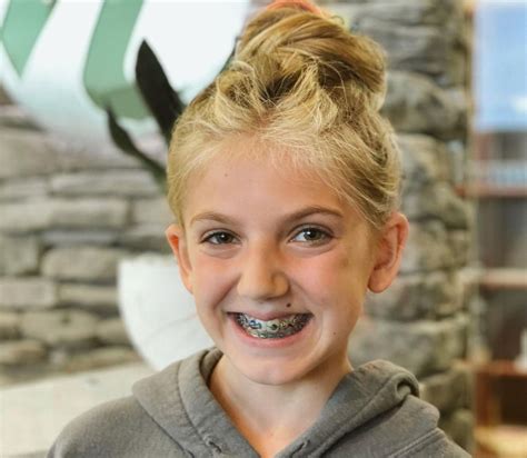 How Do Braces Move Teeth The Process