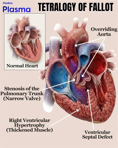 Medico Tetralogy Of Fallot Tof Tetralogy Of Fallot Is The Most