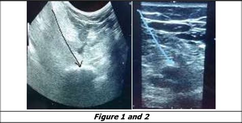 Figure 1 From Comparing Continuous Adductor Canal Block Alone With Combined Continuous Adductor