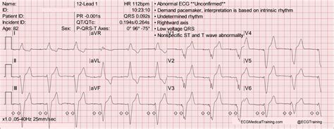Biventricular Pacemaker Rhythm Strip