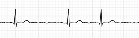 Atrial Flutter With Rvr Atrial Fibrillation Assessment Tips Via A