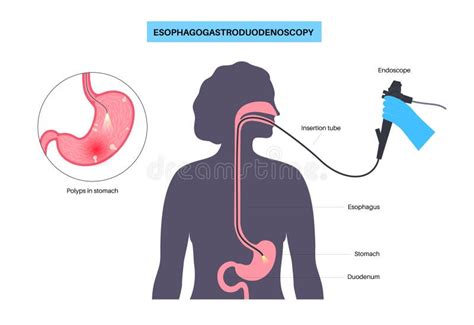 Egd System Stock Illustrations 123 Egd System Stock Illustrations Vectors And Clipart Dreamstime