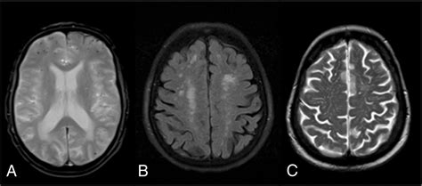 Sex Specific Patterns Of Cerebral Atrophy And Enlarged Perivascular