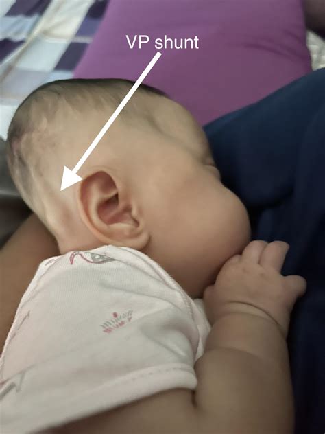 Shunt Hydrocephalus Ventriculoperitoneal Shunt For Hydrocephalus