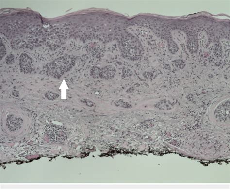 Histology Of Metatypical Basal Cell Carcinoma Basaloid Nests With Download Scientific Diagram