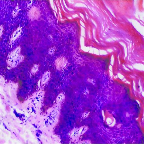 Pdf Progressive Symmetric Erythrokeratoderma With Nephrotic Syndrome Coincidence Or New