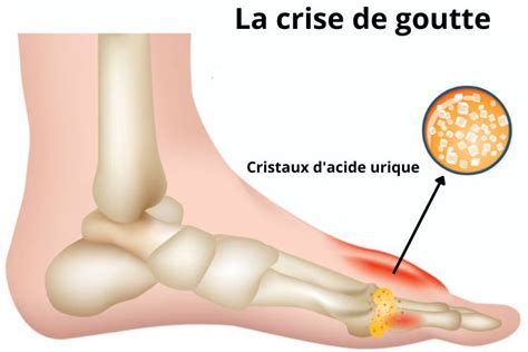 Comment est déclenchée la crise de goutte?