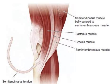 Recurrent Patellar Dislocation Case Scenario Pptx