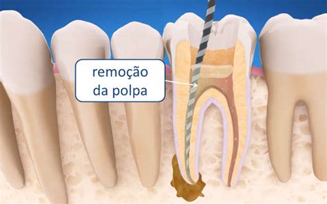 Tratamento De Canal De Dente Perguntas E Respostas Msk Odontologia