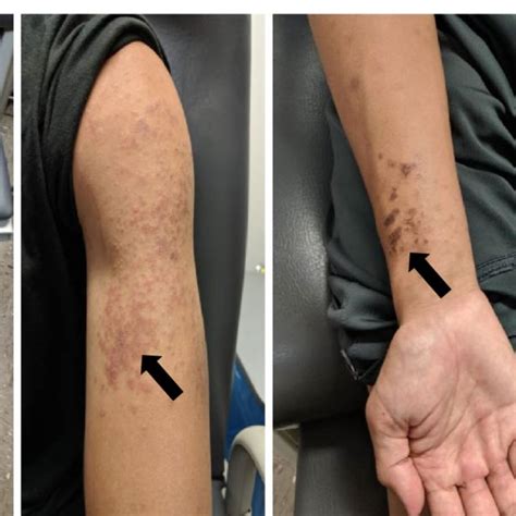 Skin Examination On Hospital Day 1 Revealing A Diffuse Hyperpigmented