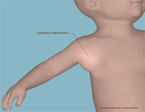 Swollen Lymph Nodes Under Arm Grosbusiness
