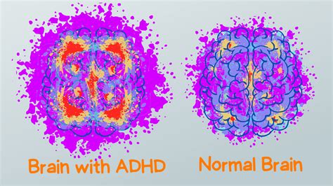 ADHD Brain Vs Normal Brain Functions Differences More