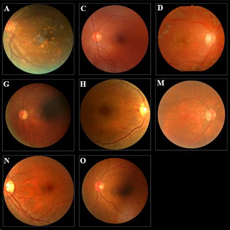 Figure 2 From Classification Of Color Fundus Photographs Using Fusion