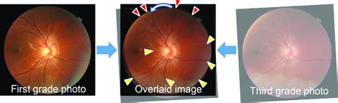 Assessment Of The Retinal Vessel Shift Using Fundus Photographs Of The
